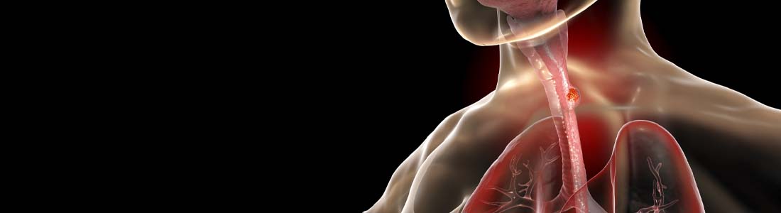 Nowotwór przełyku Prewencja | Krajowy Rejestr Nowotworów