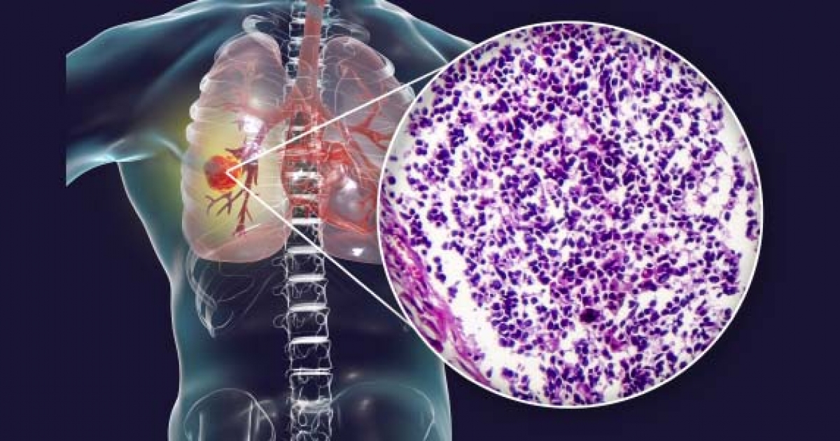 Nowotwory płuca i opłucnej Czym są? | Krajowy Rejestr Nowotworów