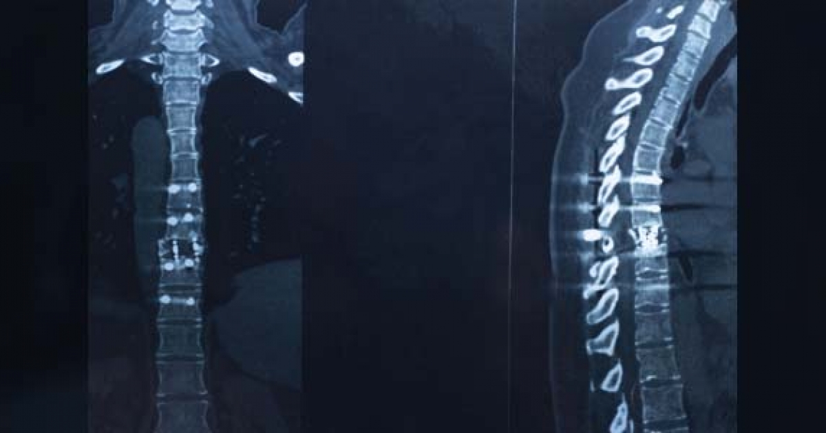 Szpiczak mnogi Diagnostyka | Krajowy Rejestr Nowotworów