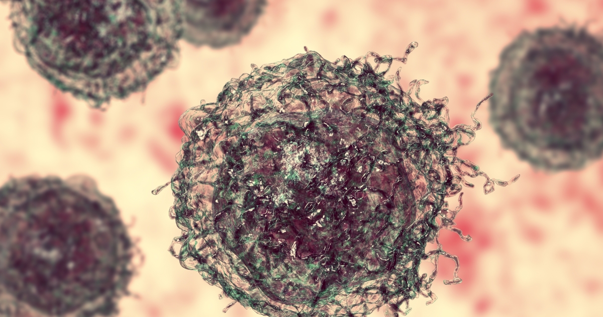 Nowotwory niedokładnie określone, wtórne, mnogie i o nieokreślonym ...